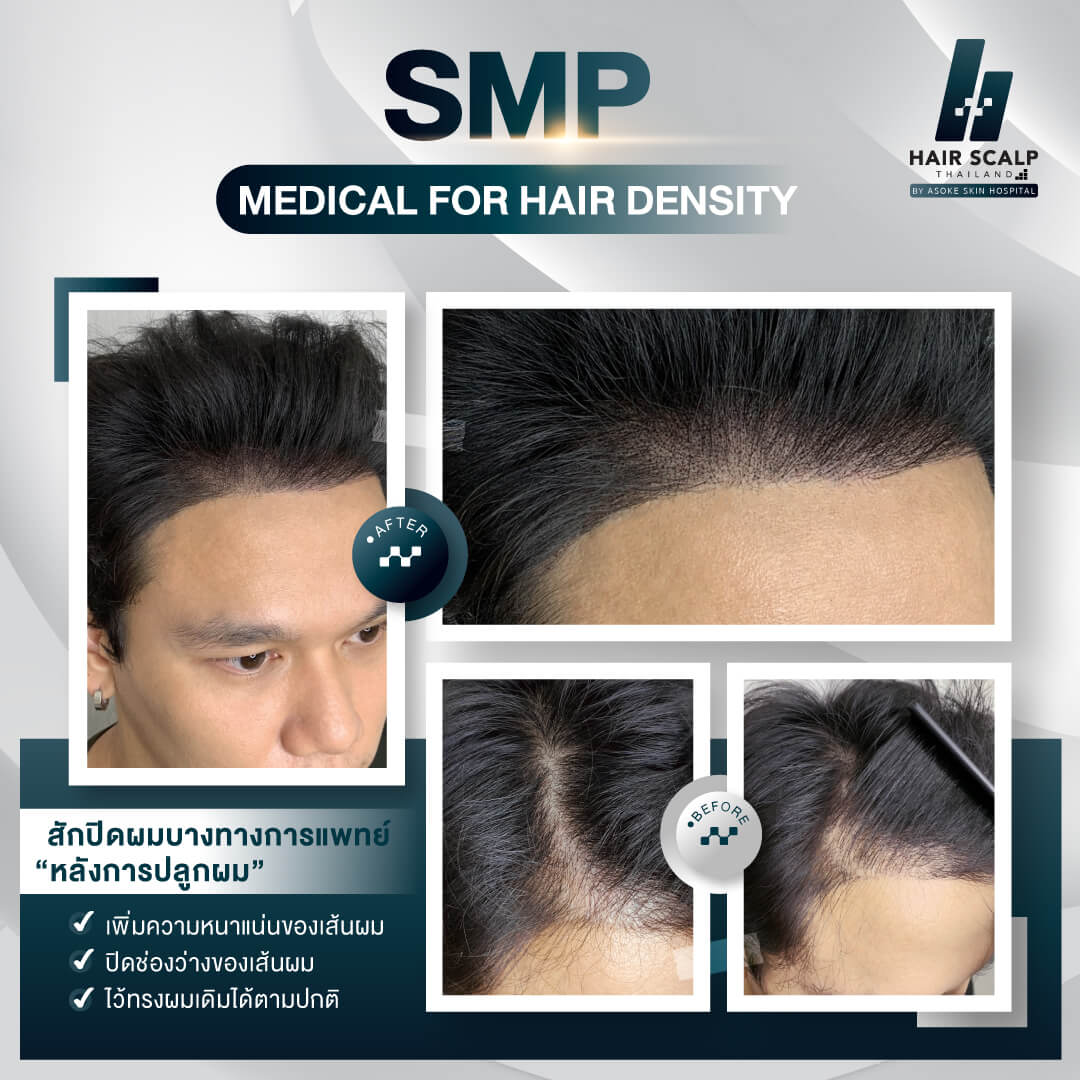 SMP for Hair Density - HAIRSCALP THAILAND